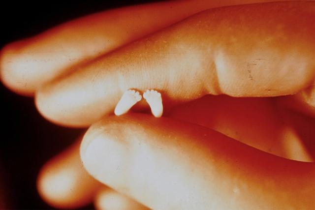 ‘Precious Feet’: Doctor’s Iconic Photo of a 10-Week-Old ‘Fetus’ Proves ...