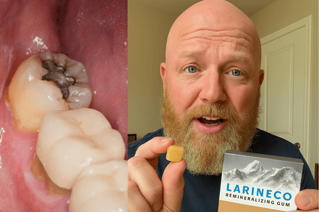 The Best Way to Repair Cavities? Just Chew This Gum Every Day