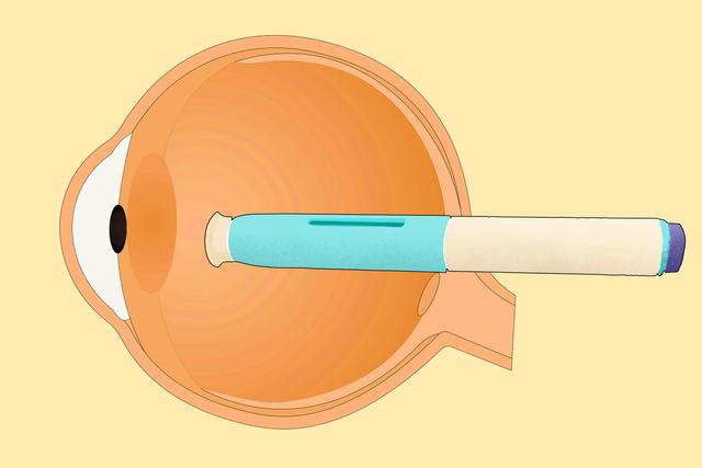 Migraine Drugs May Cut Glaucoma Risk by 25 Percent | The Epoch Times
